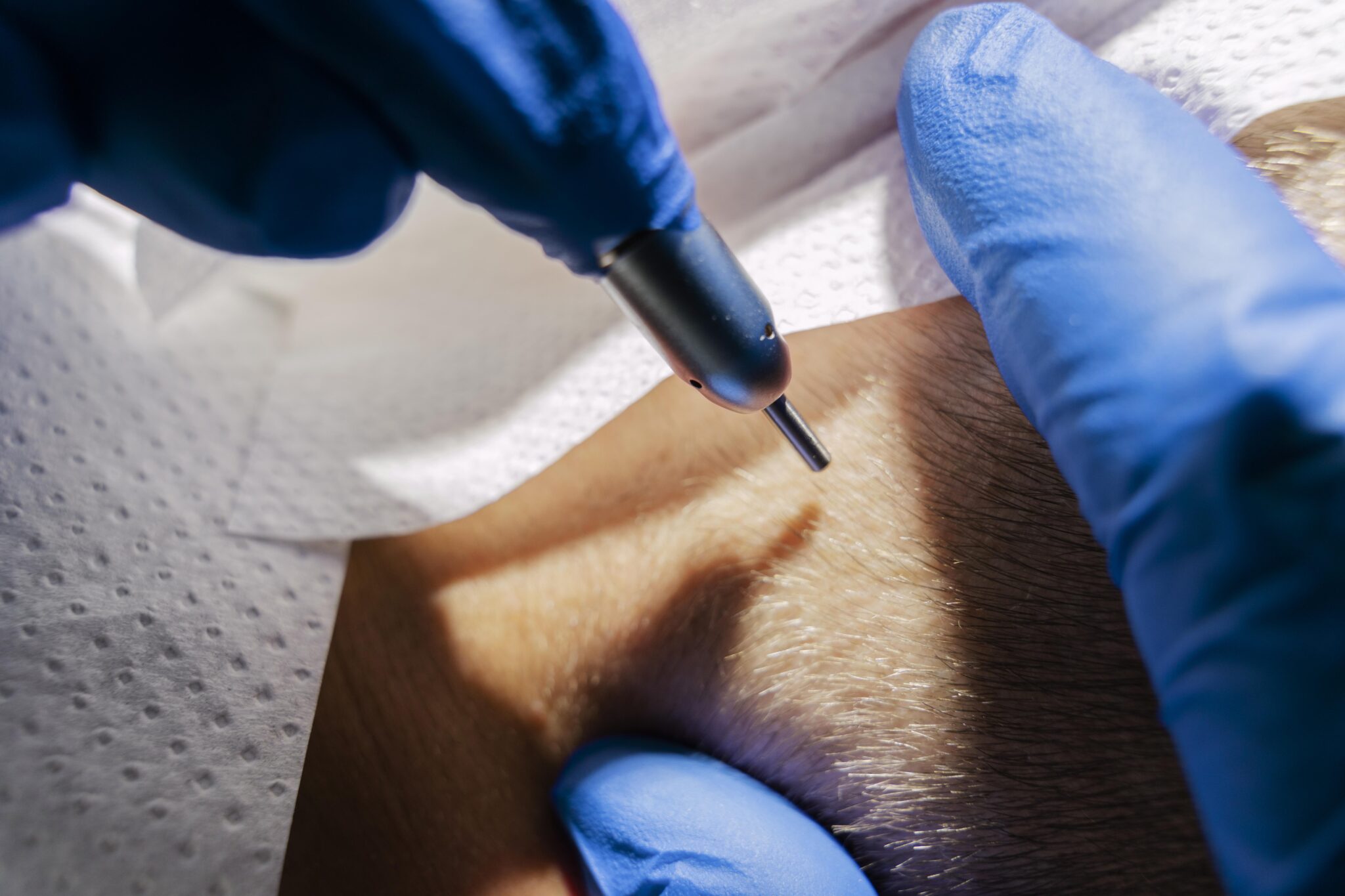 Spider Vein Treatment – Professional Radiology